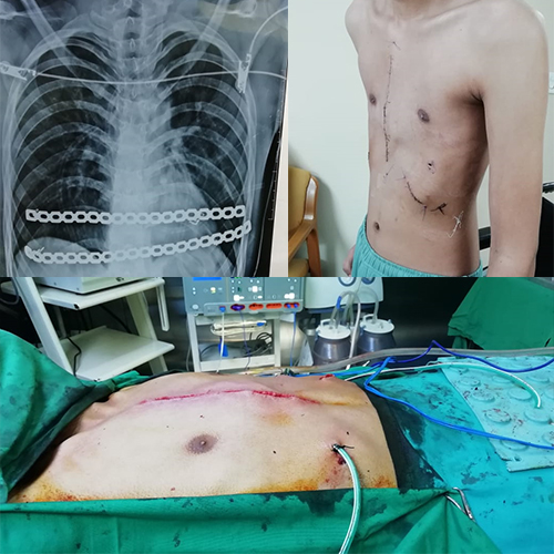 Chest Wall Deformities Reconstructive Surgery Offerred At Kih Kulsum Chest Wall Deformities Reconstructive Surgery Offerred At Kih Kulsum